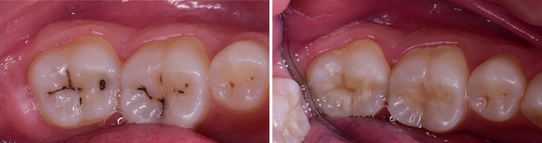 Restoring Compromised Teeth - Collaroy Dental